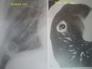 CXR - Cavity in Lung | PPT