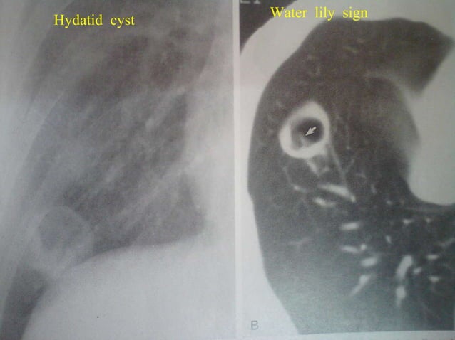 CXR - Cavity in Lung | PPT