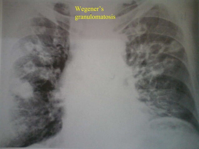 CXR - Cavity in Lung | PPT