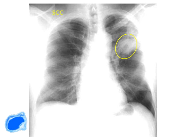CXR - Cavity in Lung | PPT
