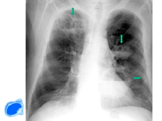 CXR - Cavity in Lung | PPT