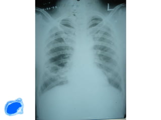 CXR - Cavity in Lung | PPT