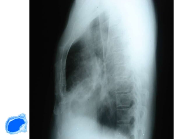 CXR - Cavity in Lung | PPT