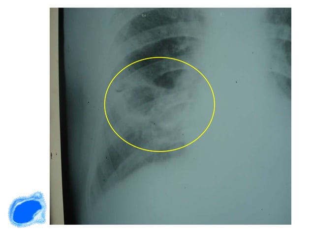 CXR - Cavity in Lung | PPT