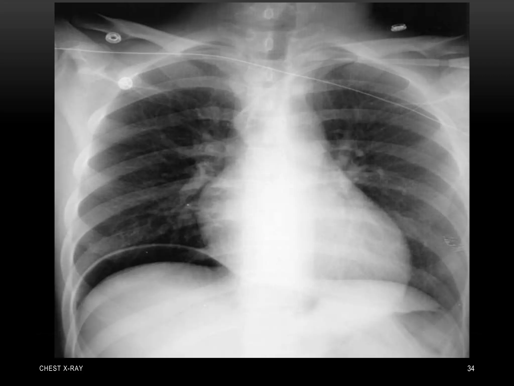 Basics of CXR | PPTX