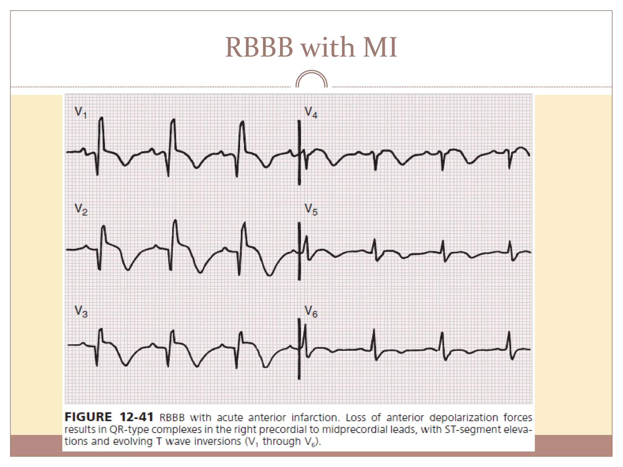 basic ecg diagnosis | PPT