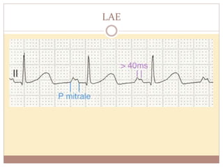basic ecg diagnosis | PPTX