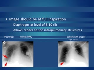 basics about chest x ray for all branches of medical science.pptx