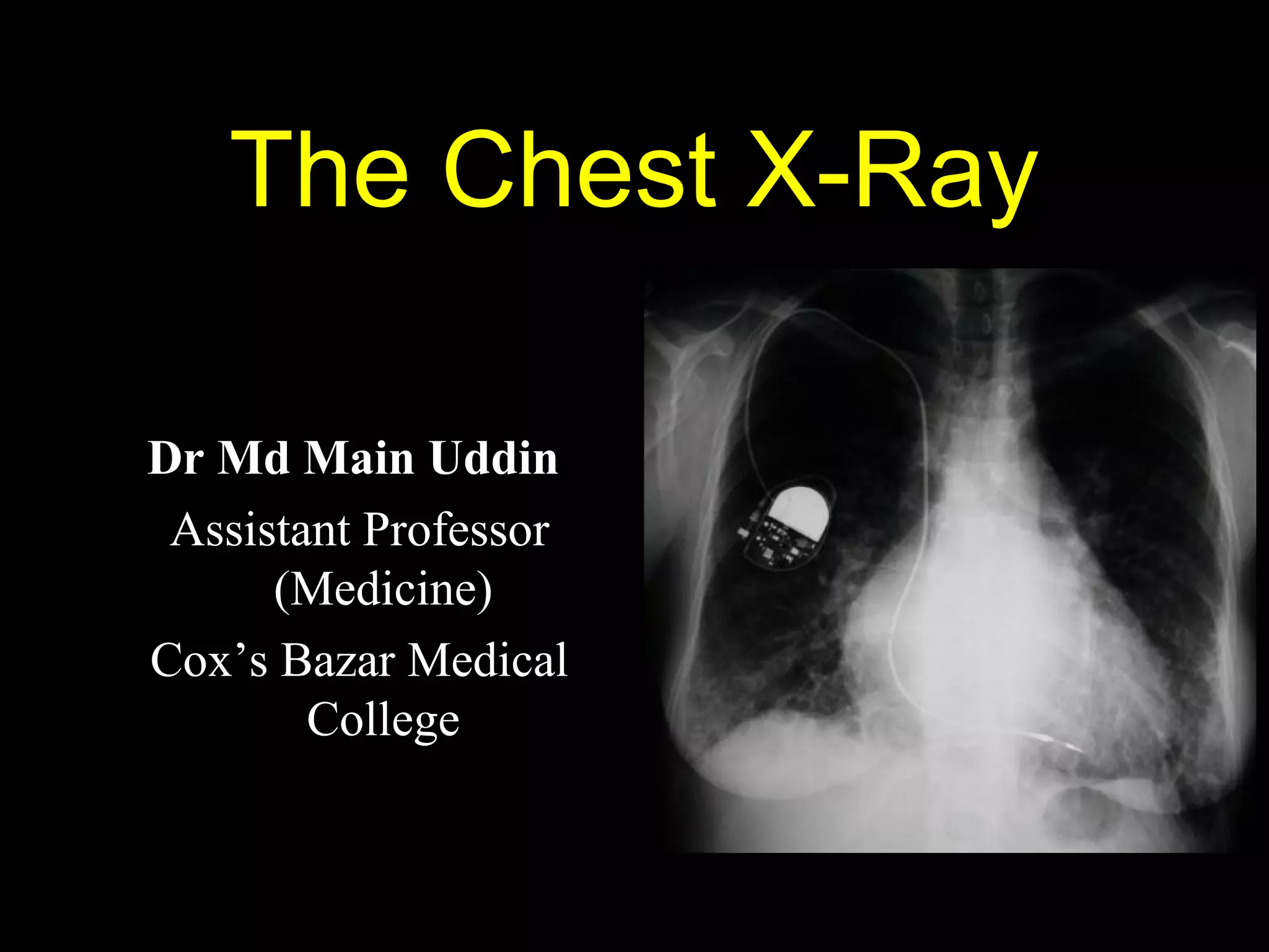 Interpretation of Chest X-Ray PPT | PPT
