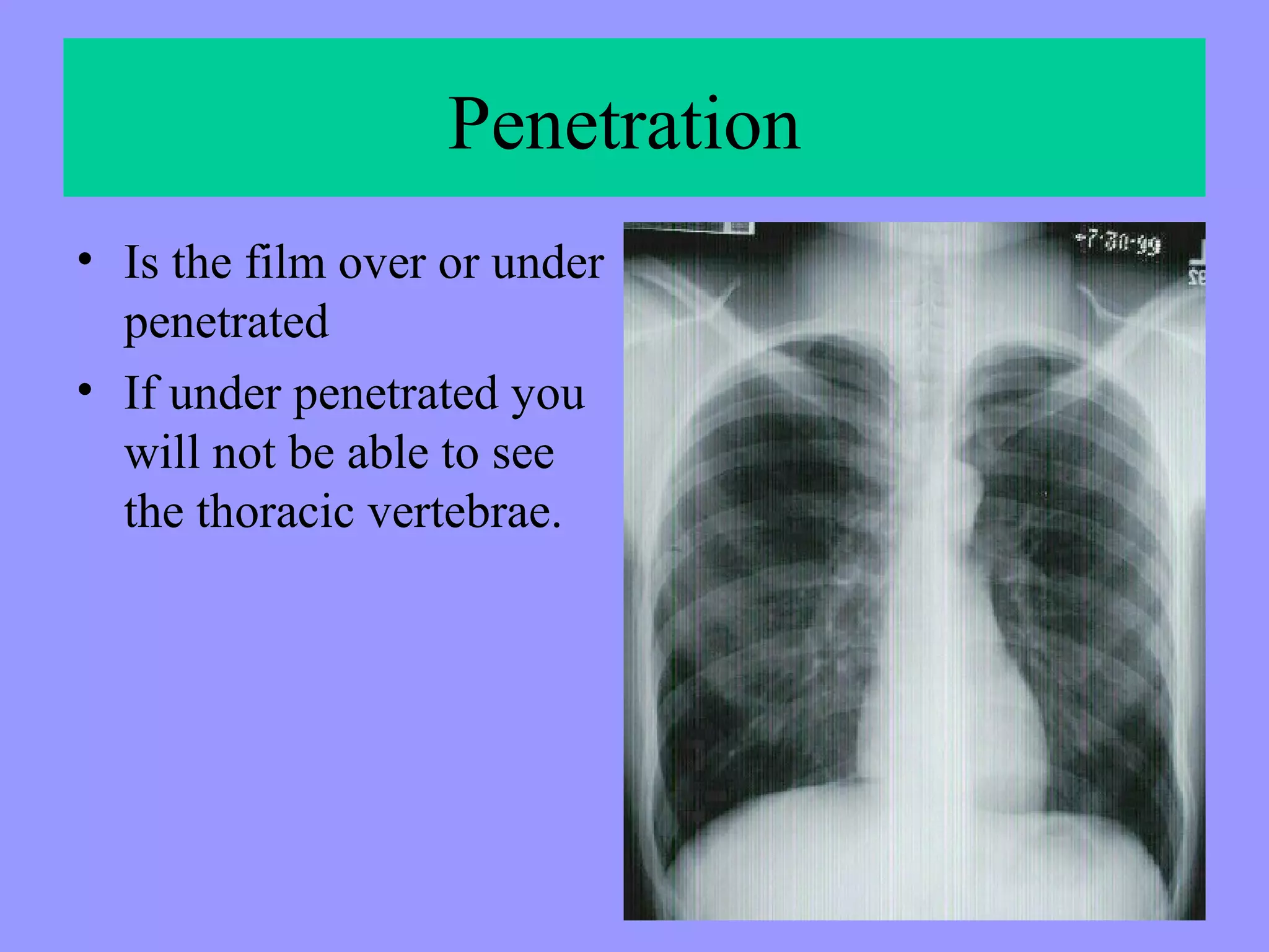 Interpretation of Chest X-Ray PPT | PPT