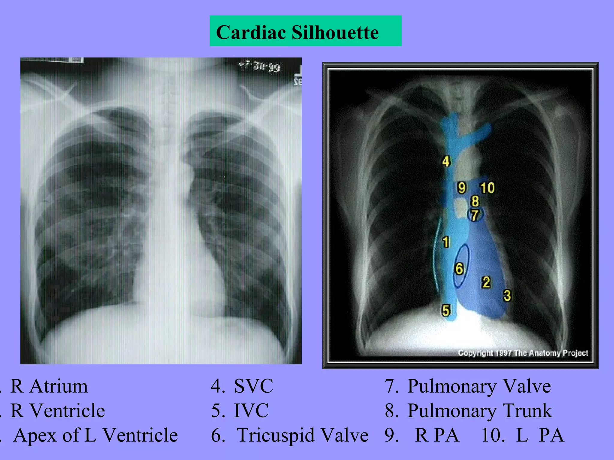 Interpretation of Chest X-Ray PPT | PPT