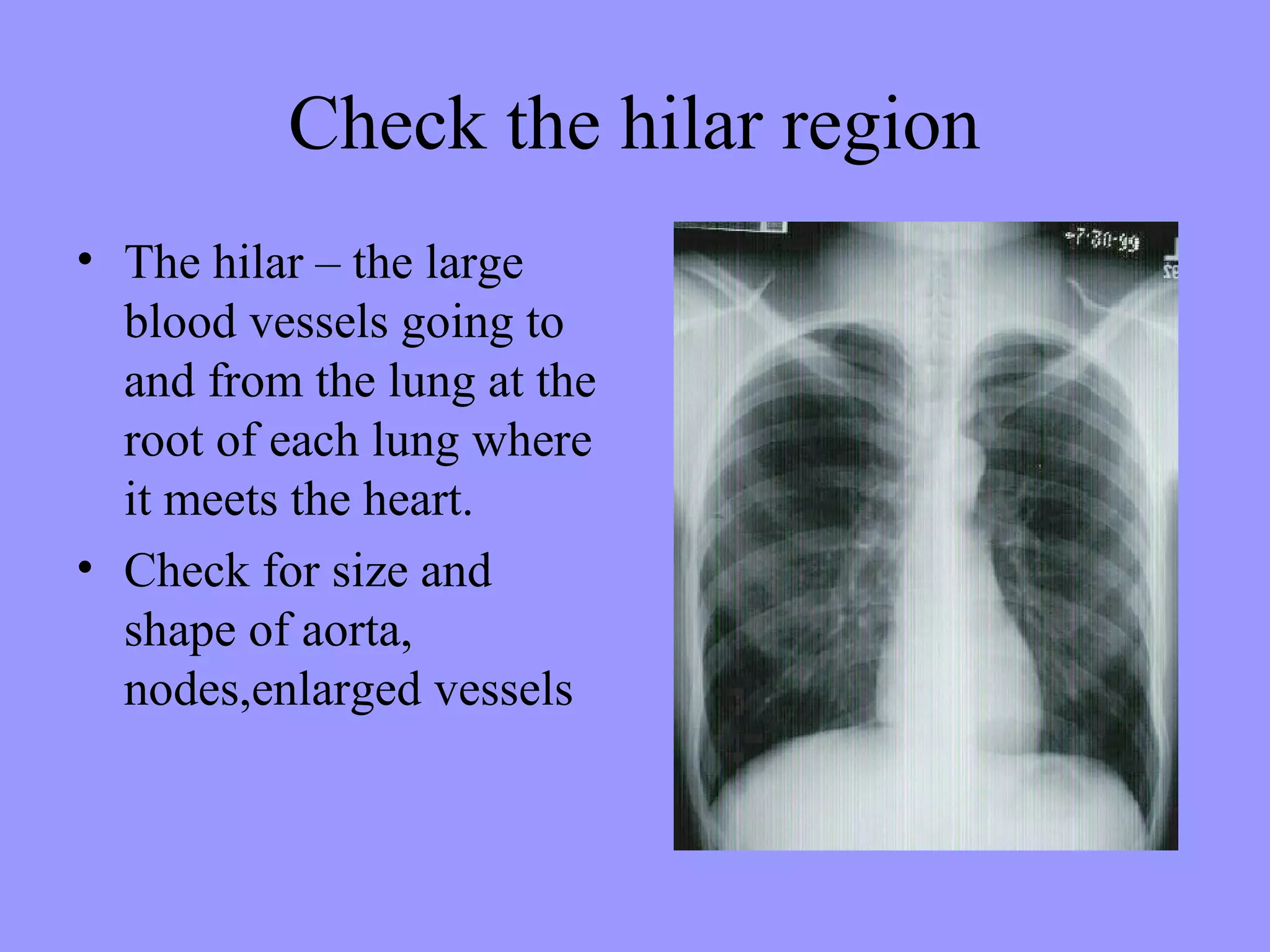 Interpretation of Chest X-Ray PPT | PPT