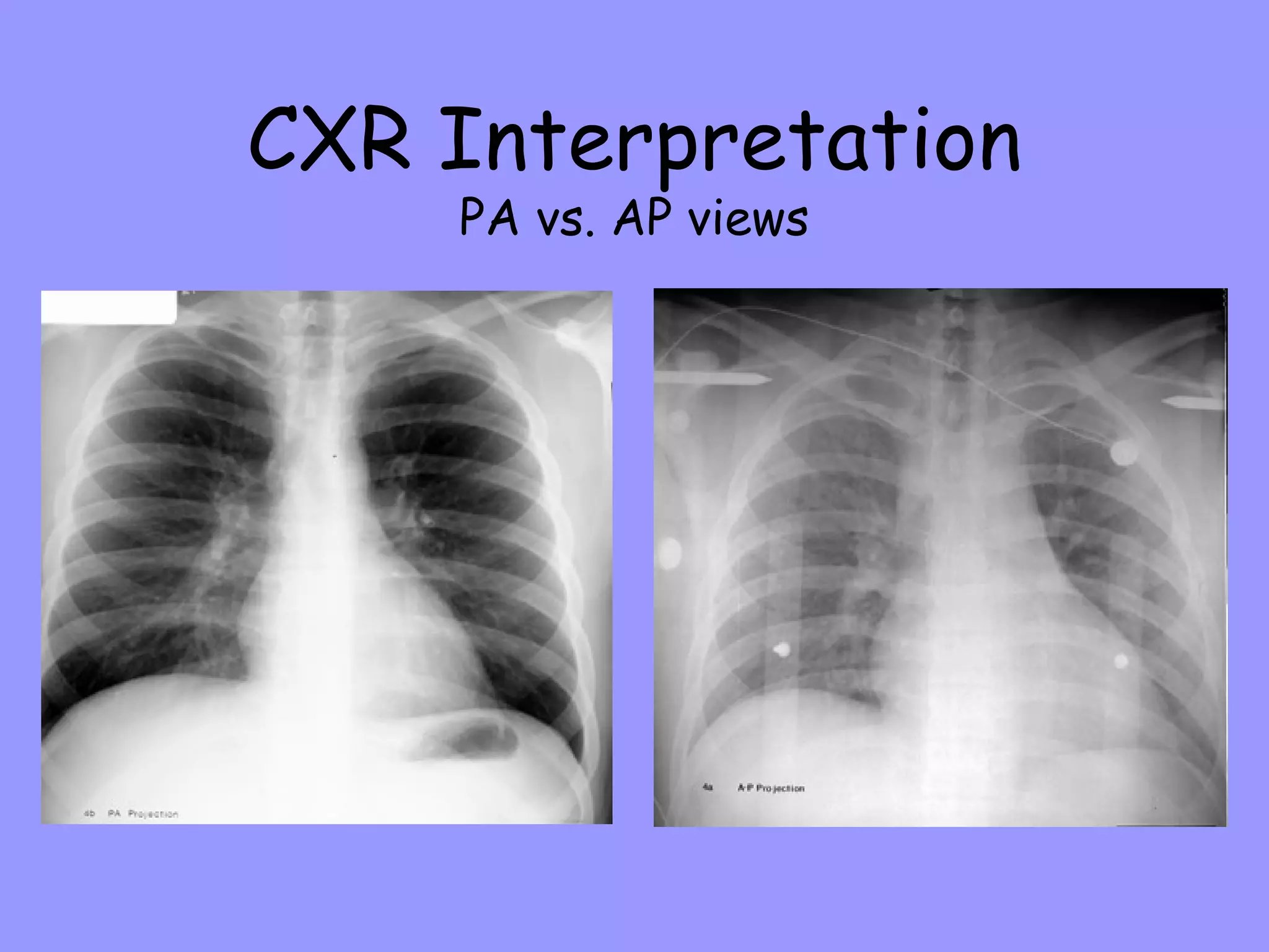 Interpretation of Chest X-Ray PPT | PPT