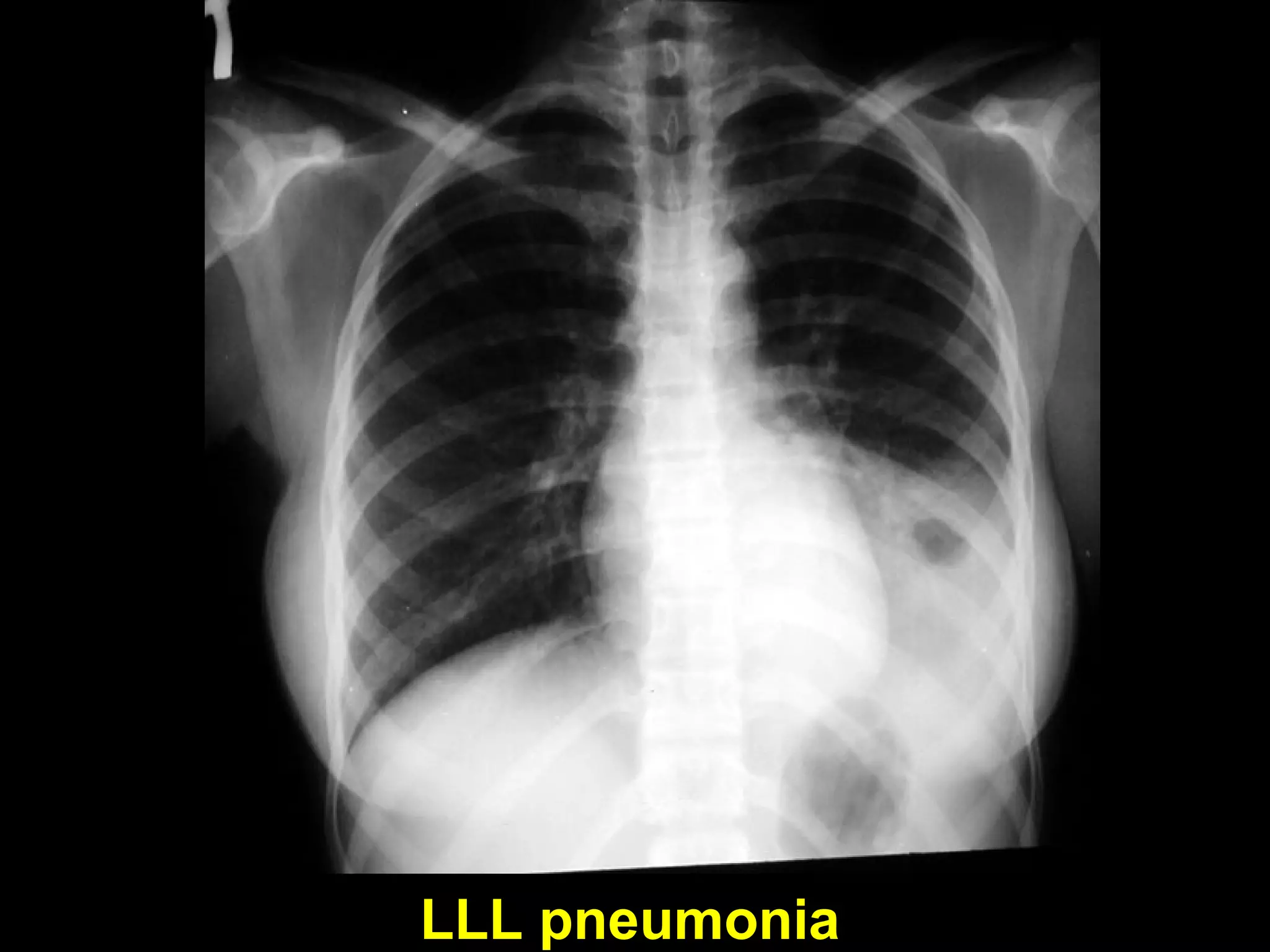 Interpretation of Chest X-Ray PPT | PPT