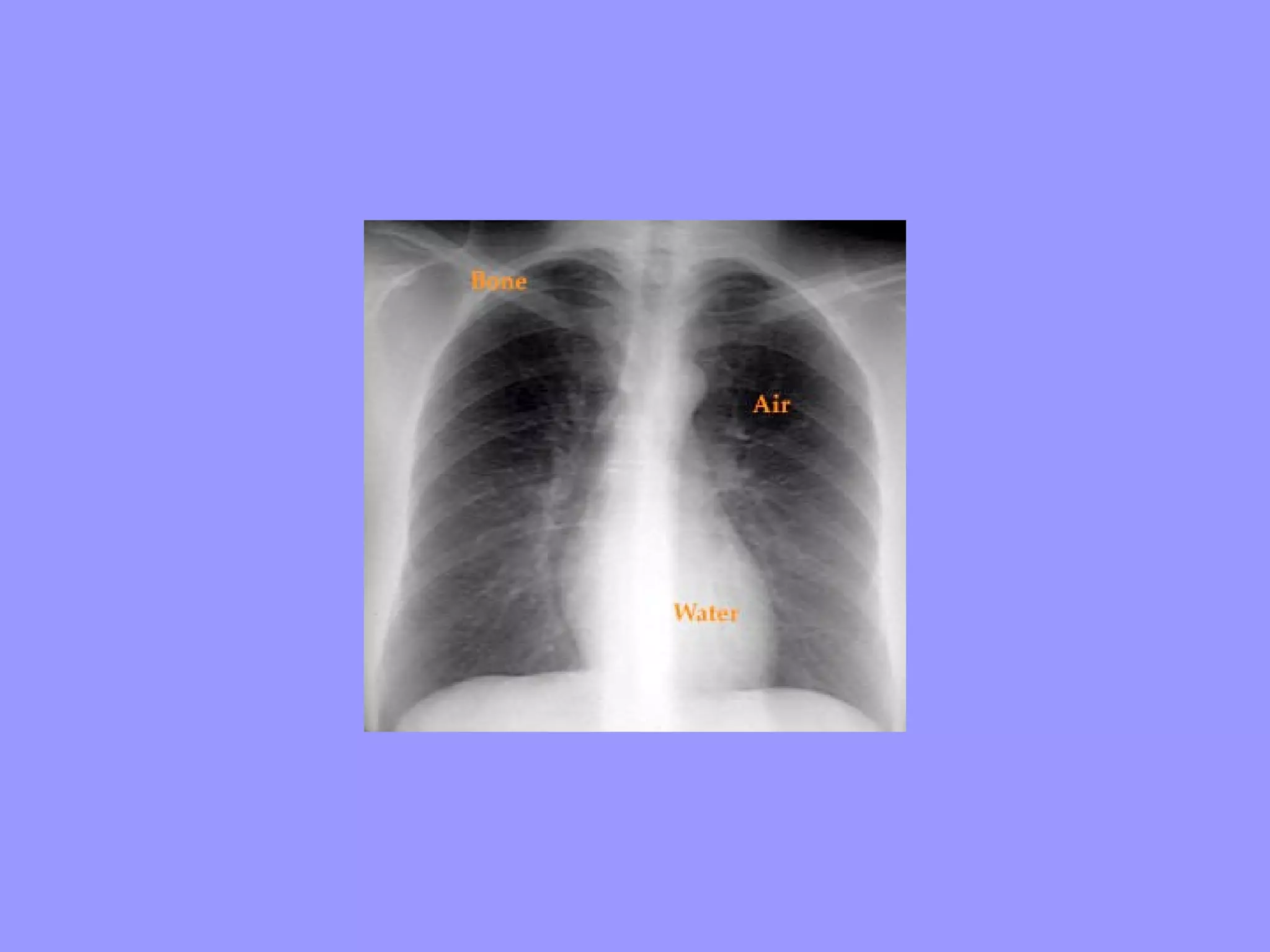 Interpretation of Chest X-Ray PPT | PPT