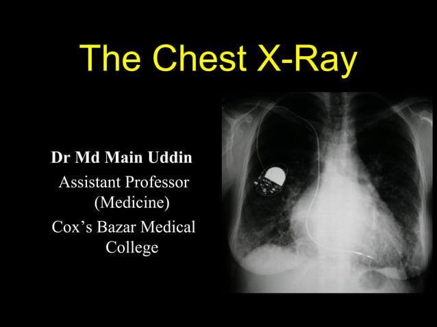 Interpretation of Chest X-Ray PPT | PPT | Heart and Cardiovascular Diseases | Diseases and ...