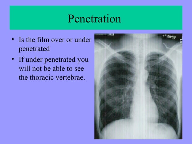 Interpretation of Chest X-Ray PPT | PPT | Heart and Cardiovascular ...