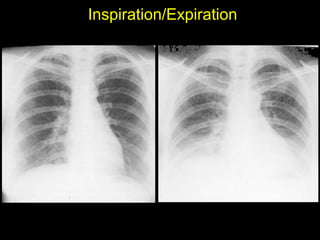 Interpretation of Chest X-Ray PPT | PPT