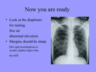 Interpretation of Chest X-Ray PPT | PPT
