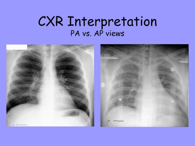 Interpretation of Chest X-Ray PPT | PPT | Heart and Cardiovascular ...