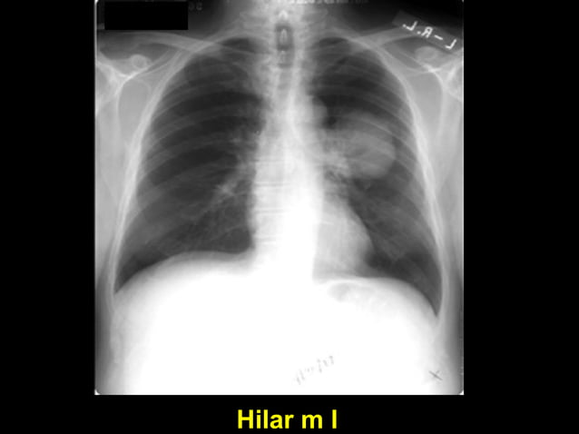 Interpretation of Chest X-Ray PPT | PPT | Heart and Cardiovascular ...