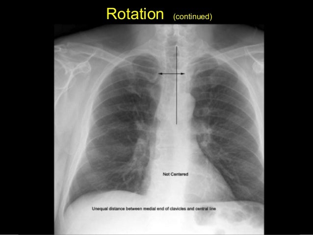 Interpretation of Chest X-Ray PPT