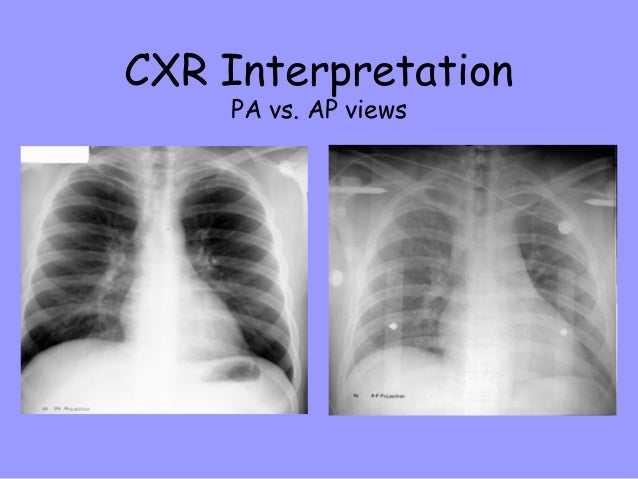 Interpretation of Chest X-Ray PPT