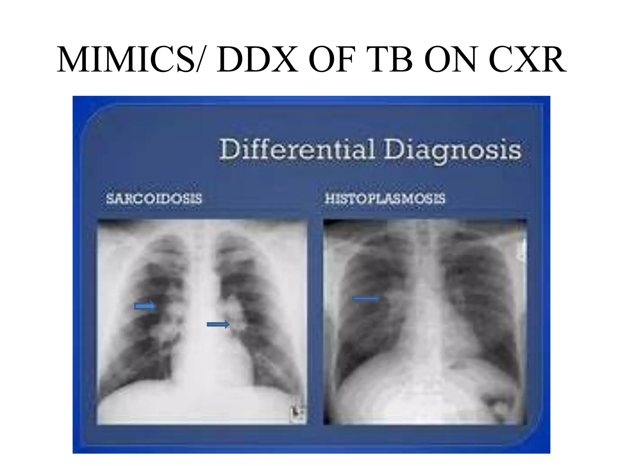 CXR interpretation in TB patients | PPTX