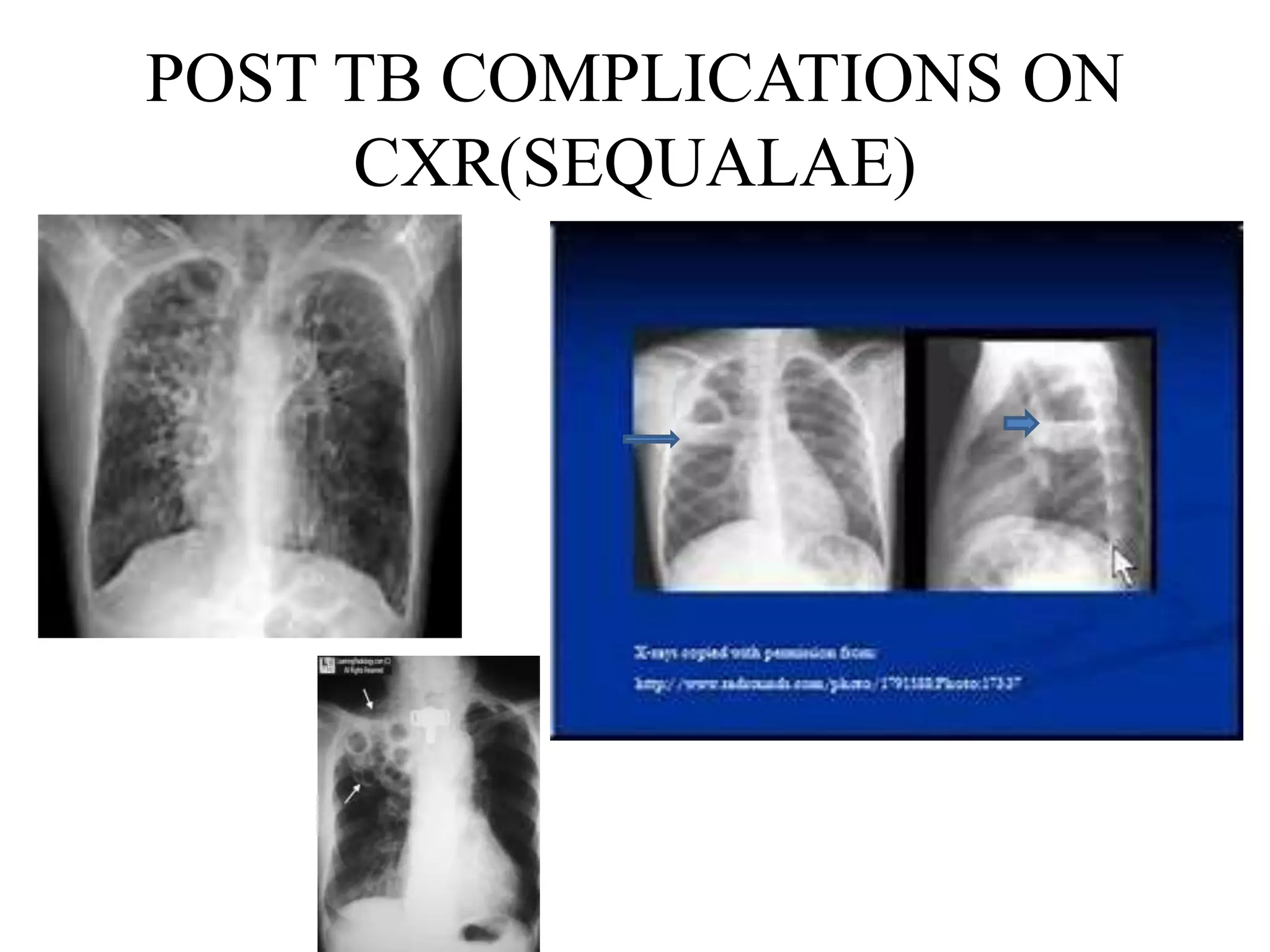 CXR interpretation in TB patients | PPTX