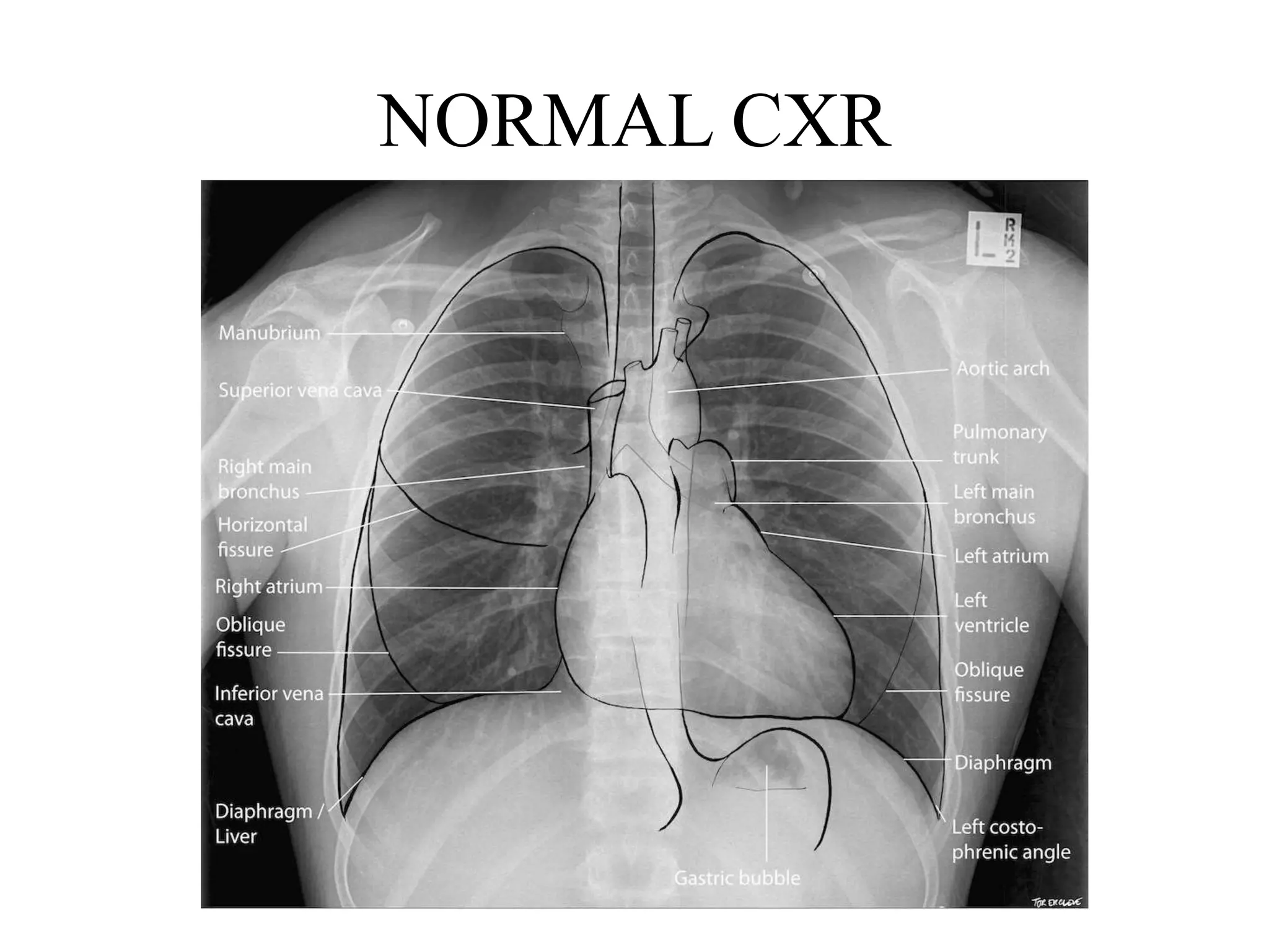 CXR interpretation in TB patients | PPTX