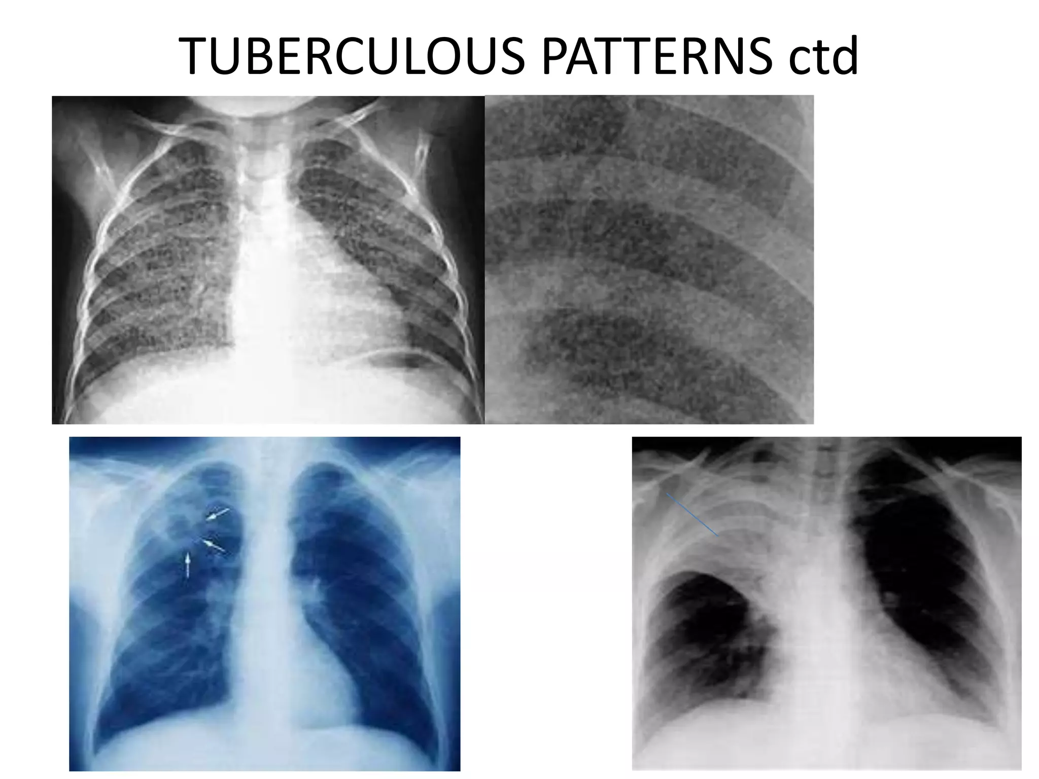 CXR interpretation in TB patients | PPTX