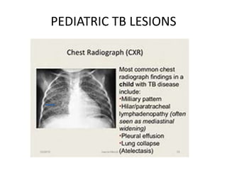 CXR interpretation in TB patients | PPT