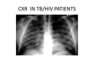 CXR interpretation in TB patients | PPT