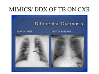 CXR interpretation in TB patients | PPT