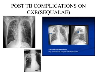 CXR interpretation in TB patients | PPT