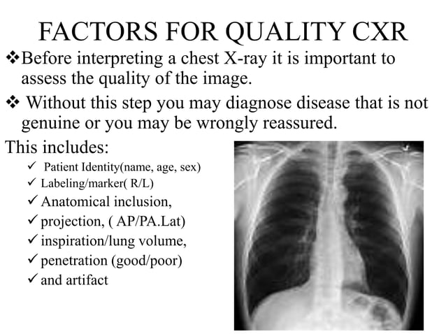CXR interpretation in TB patients | PPT | Free Download