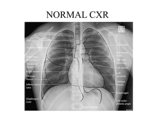 CXR interpretation in TB patients | PPT | Free Download