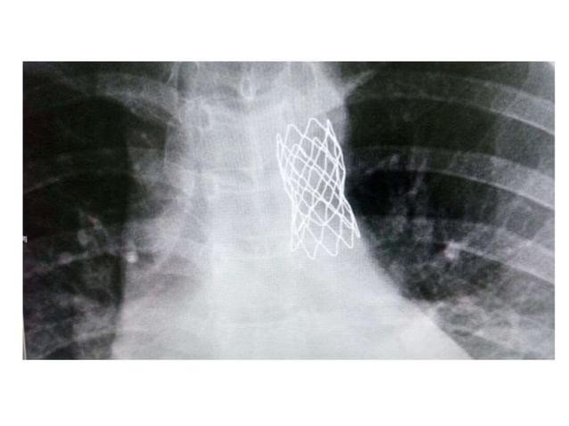Cxr findings in cardiology | PPTX | Heart and Cardiovascular Diseases ...