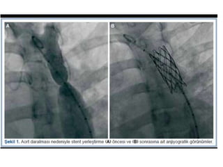 Cxr findings in cardiology | PPTX