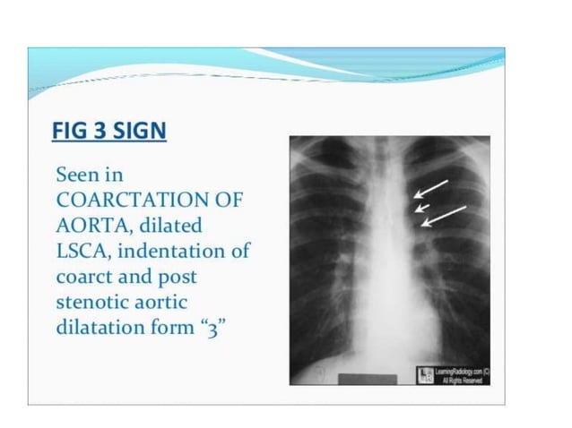 Cxr findings in cardiology | PPTX | Heart and Cardiovascular Diseases ...