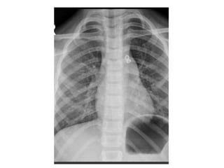 Cxr findings in cardiology | PPTX