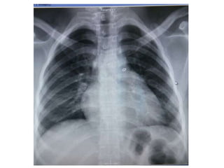 Cxr findings in cardiology | PPTX