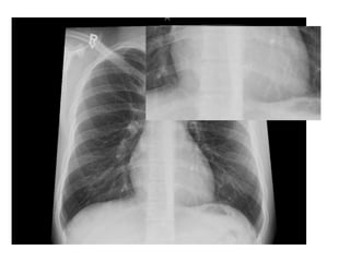Cxr findings in cardiology | PPTX