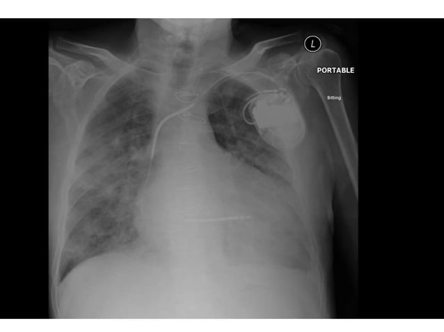 Cxr findings in cardiology | PPTX | Heart and Cardiovascular Diseases ...