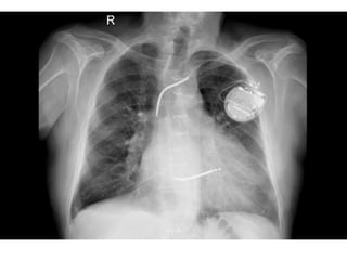 Cxr findings in cardiology | PPTX