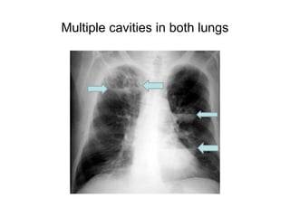 Interpretation of Chest X-Rays for Y3 medical students | PPTX