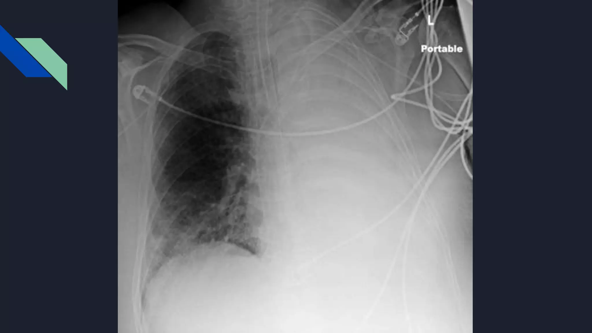 tubes on chest xrays | PPTX