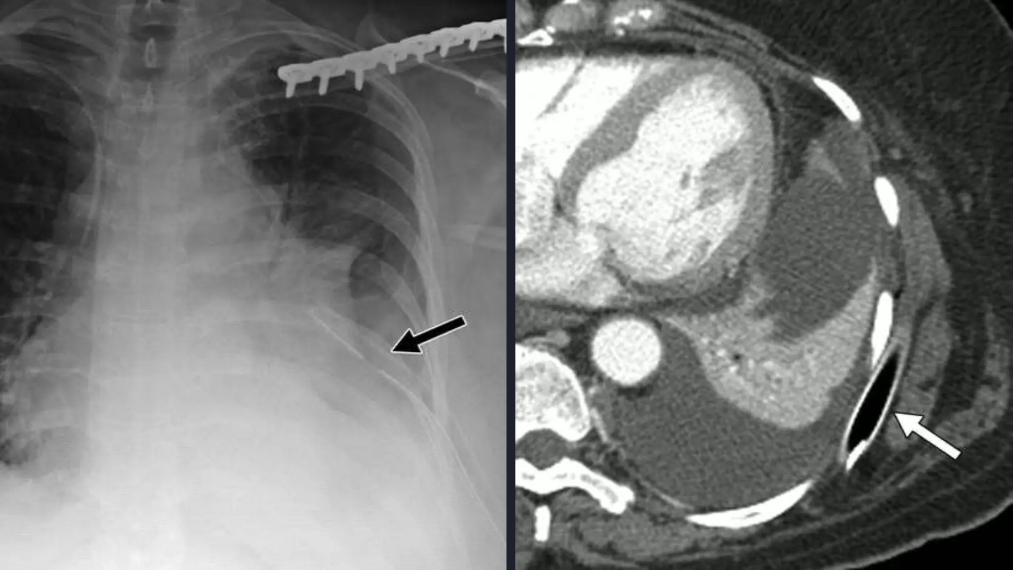 tubes on chest xrays | PPTX