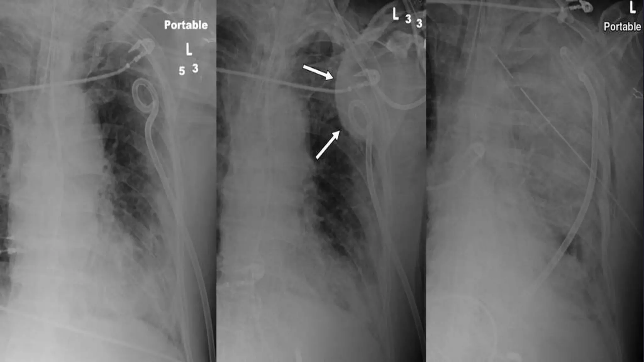 tubes on chest xrays | PPTX