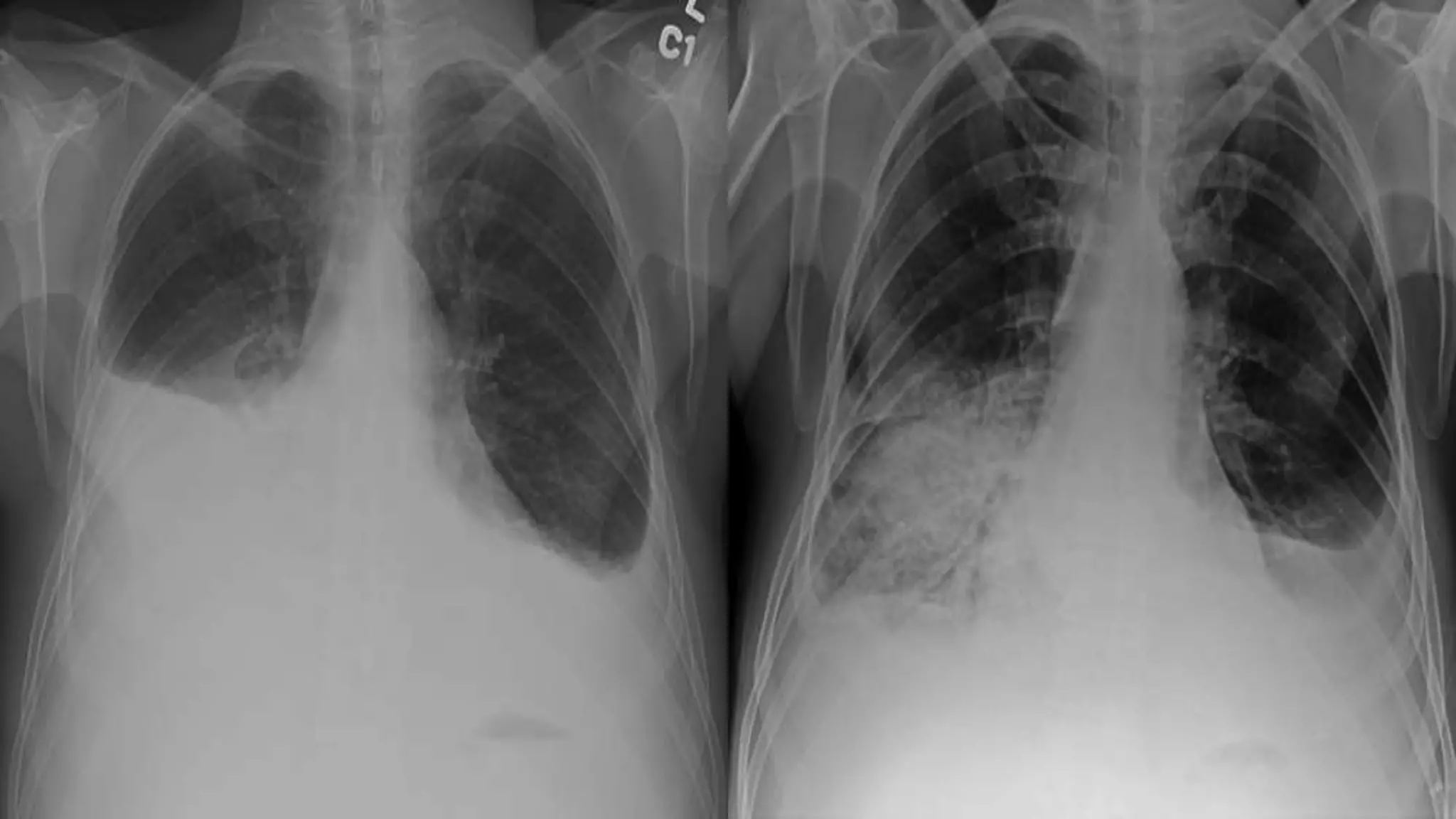 tubes on chest xrays | PPTX